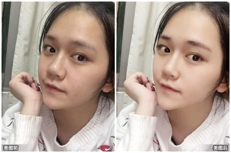 打美白针前后效果图美白针效果图前后对比美白针效果图大山谷图库