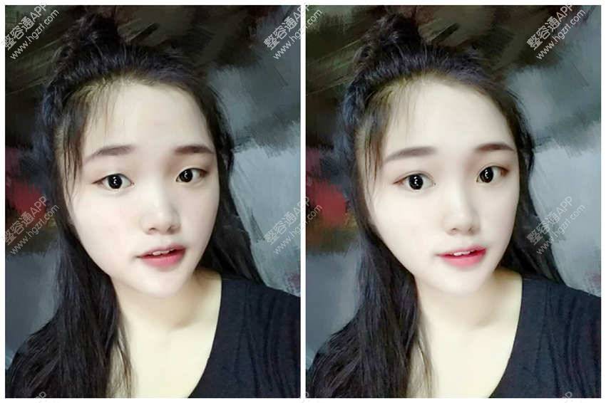 打美白针前后效果图美白针效果图前后对比美白针效果图大山谷图库